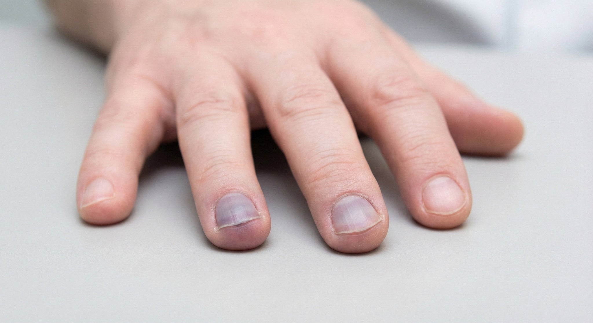 Blue Nail Beds (Cyanosis): Identifying Nail Discoloration and When to ...
